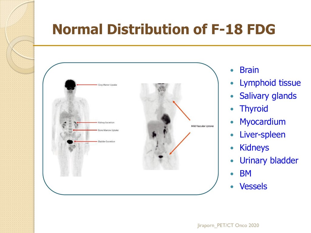 FDG PET-CT in Oncology part 2 - Speaker Deck