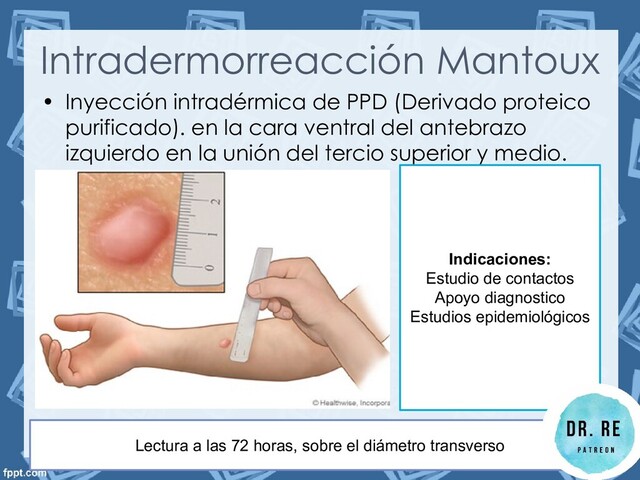 47. Tuberculosis - Speaker Deck